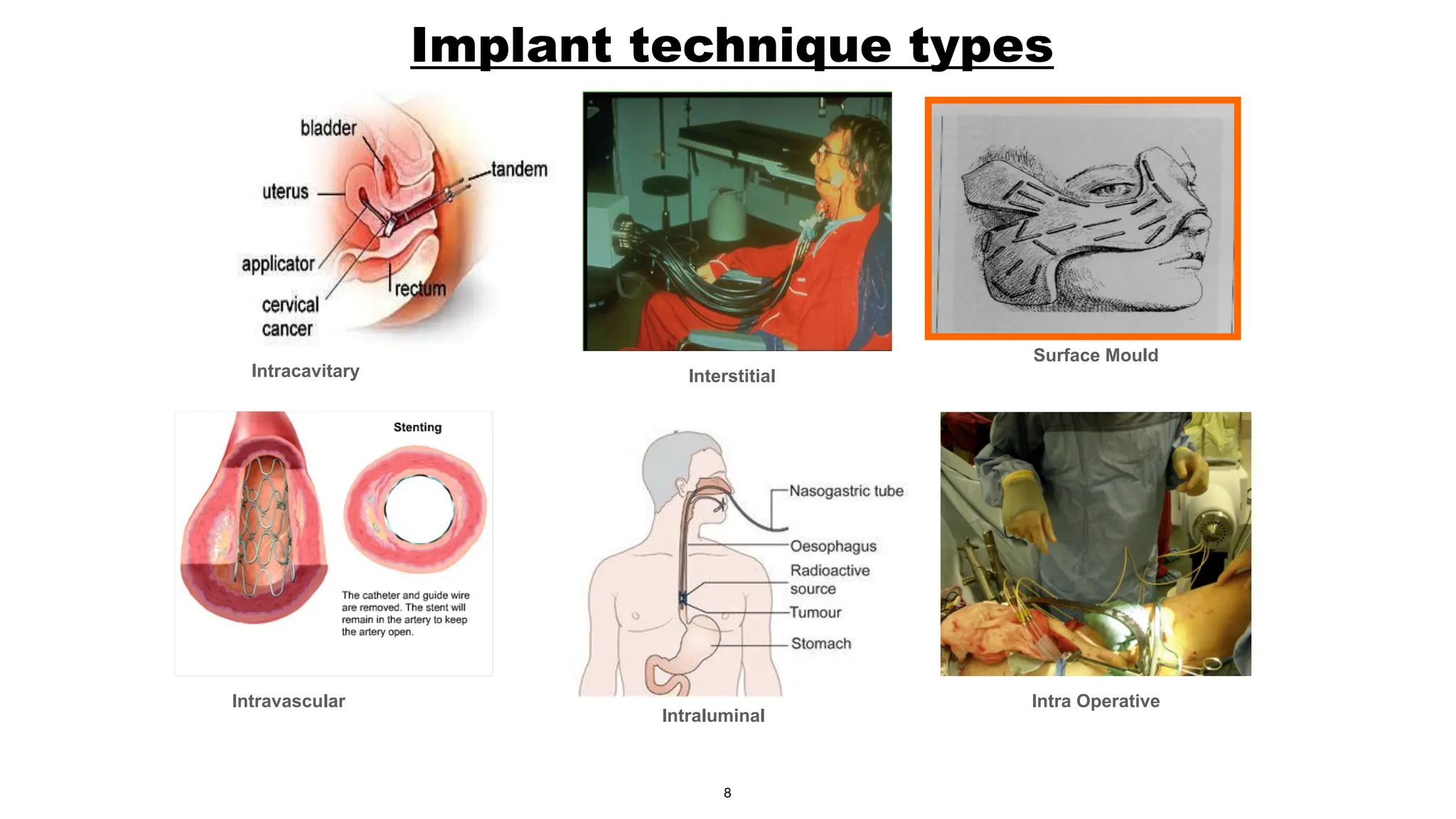 BRACHYTHERAPY OVERVIEW AND APPLICATORS | PDF