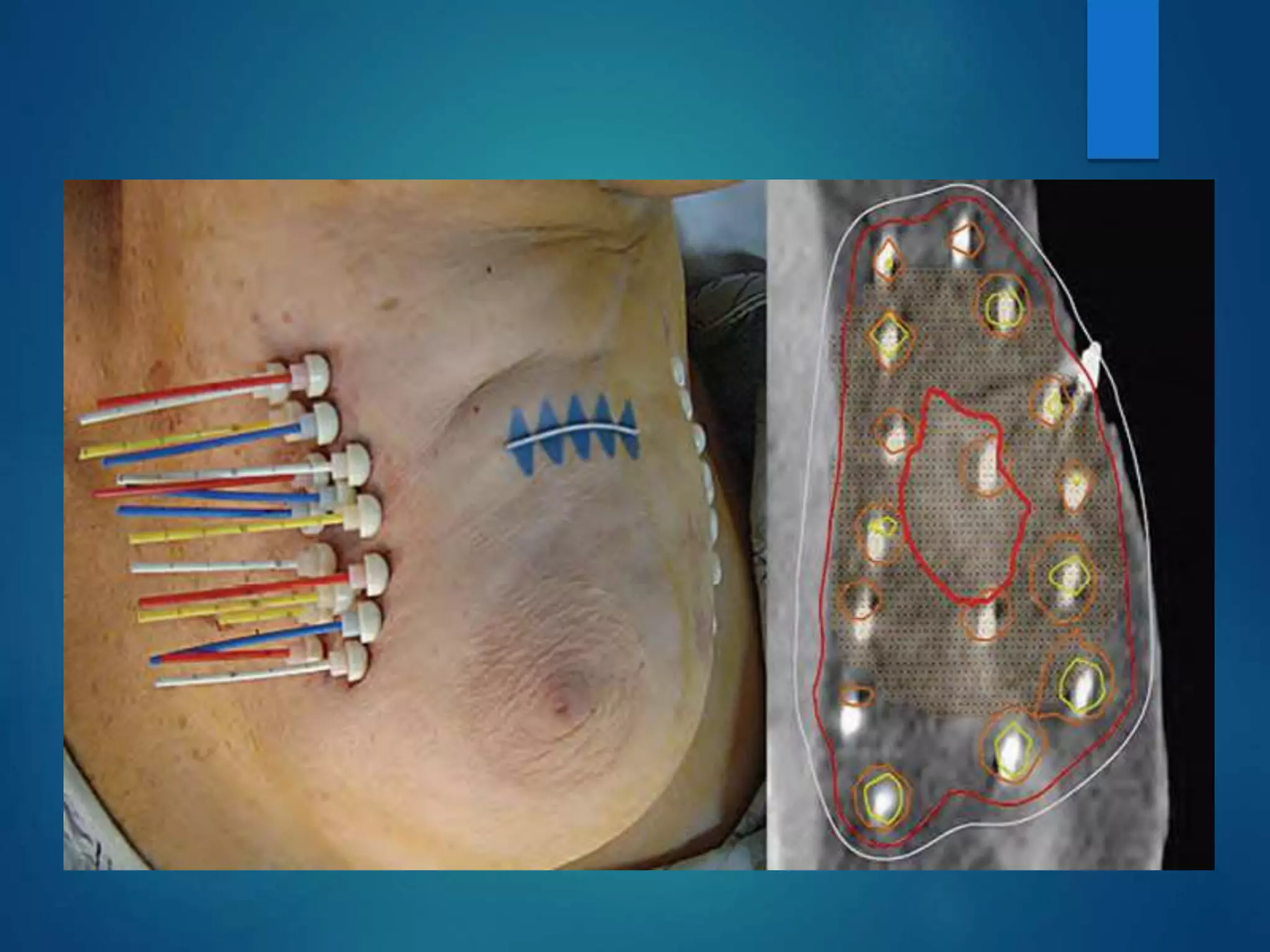 Brachytherapy in breast cancer | PPT