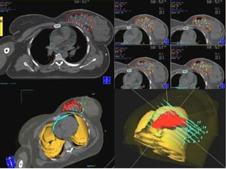 Brachytherapy in breast cancer | PPT