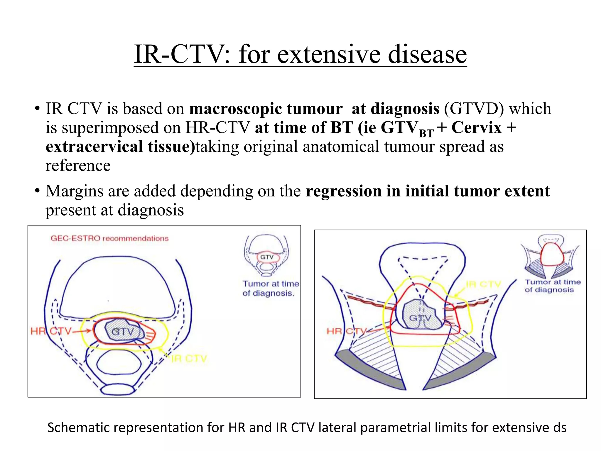 image guided brachytherapy carcinoma cervix | PPTX