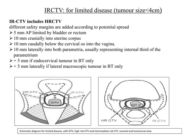 image guided brachytherapy carcinoma cervix | PPTX