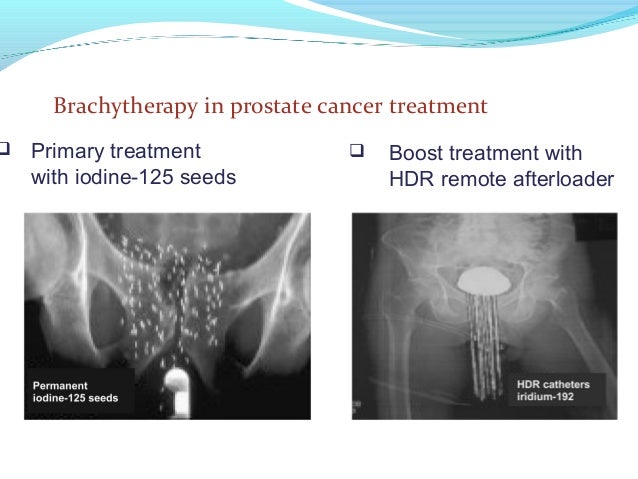 Brachytherapy msc lecture sam copy