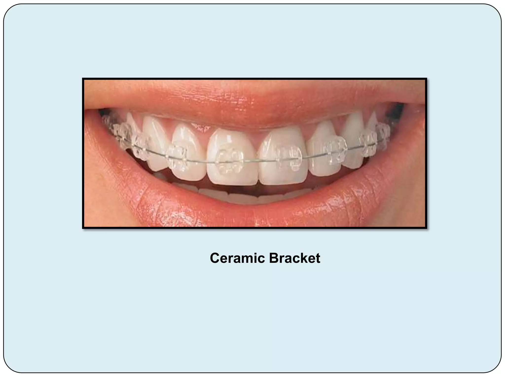 Orthodontic Bracket Materials | PPTX