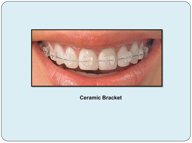 Orthodontic Bracket Materials | PPTX