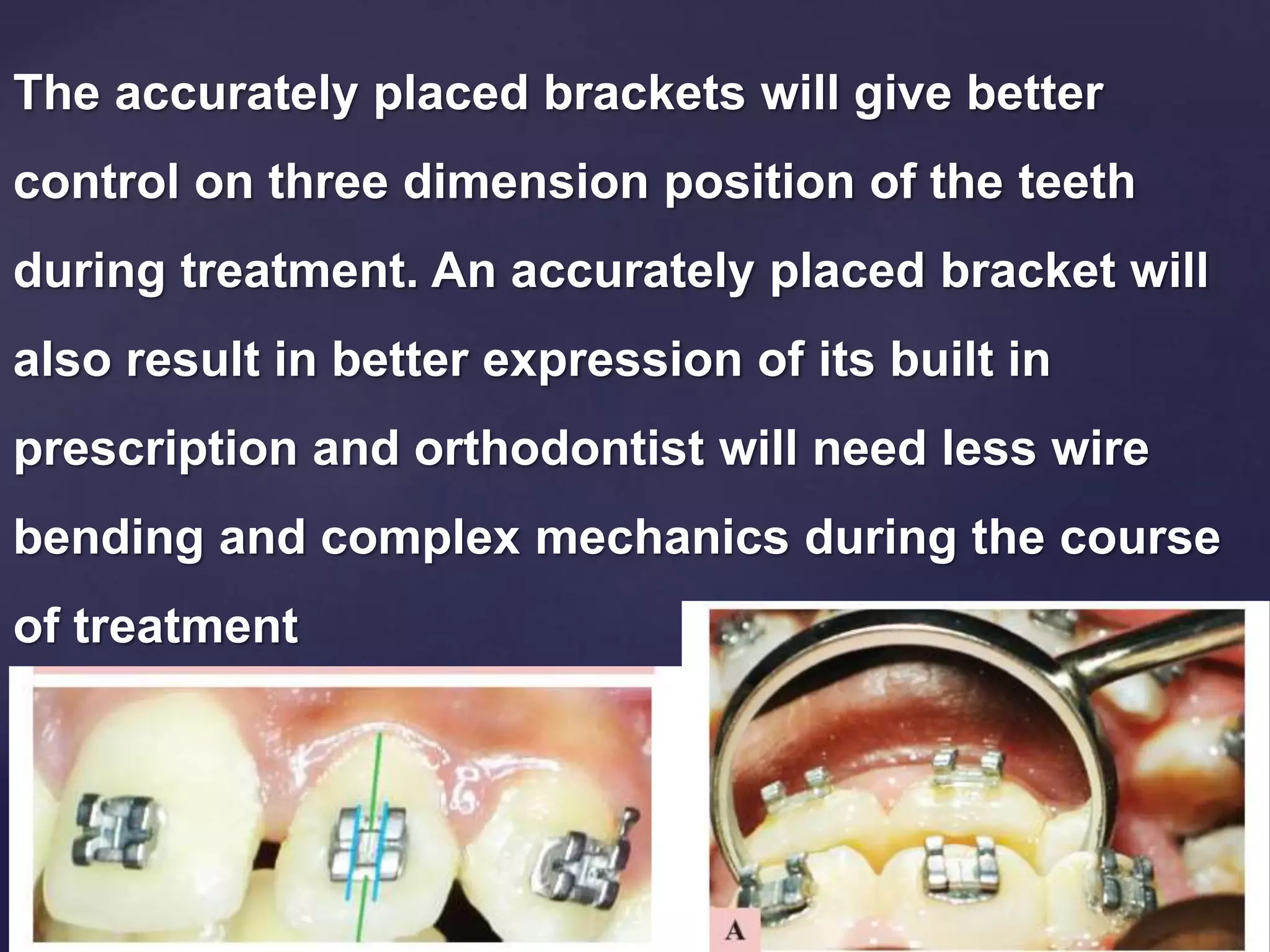 placement of orthodontic brackets | PPTX