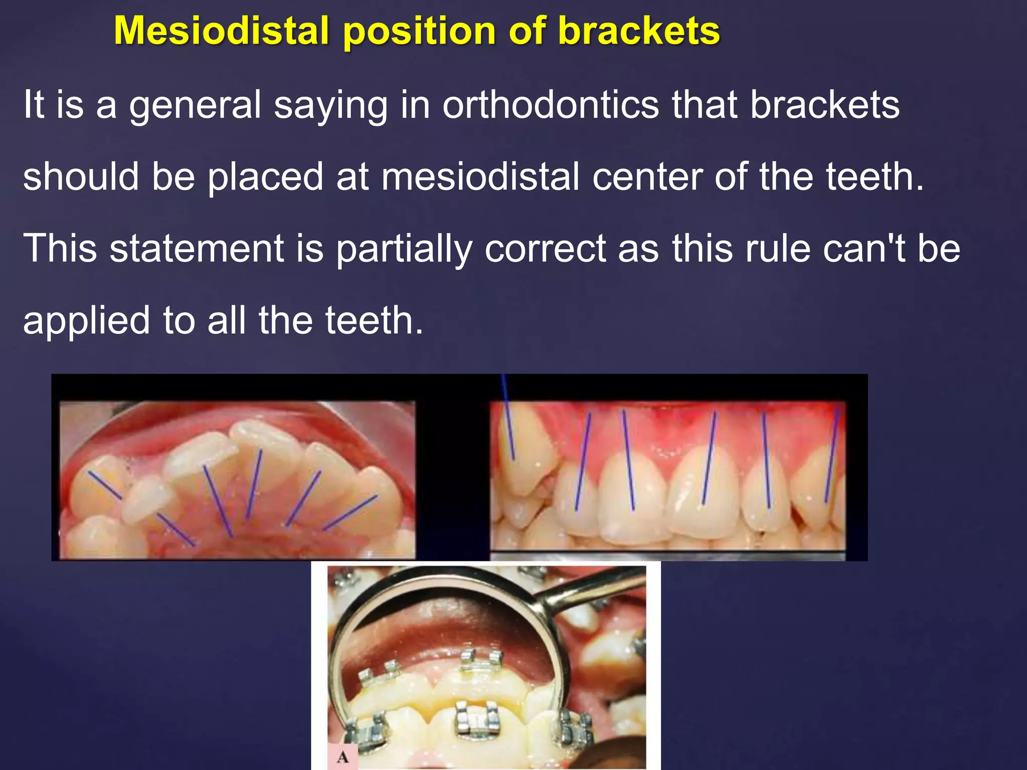 placement of orthodontic brackets | PPTX | Dental Health | Diseases and ...