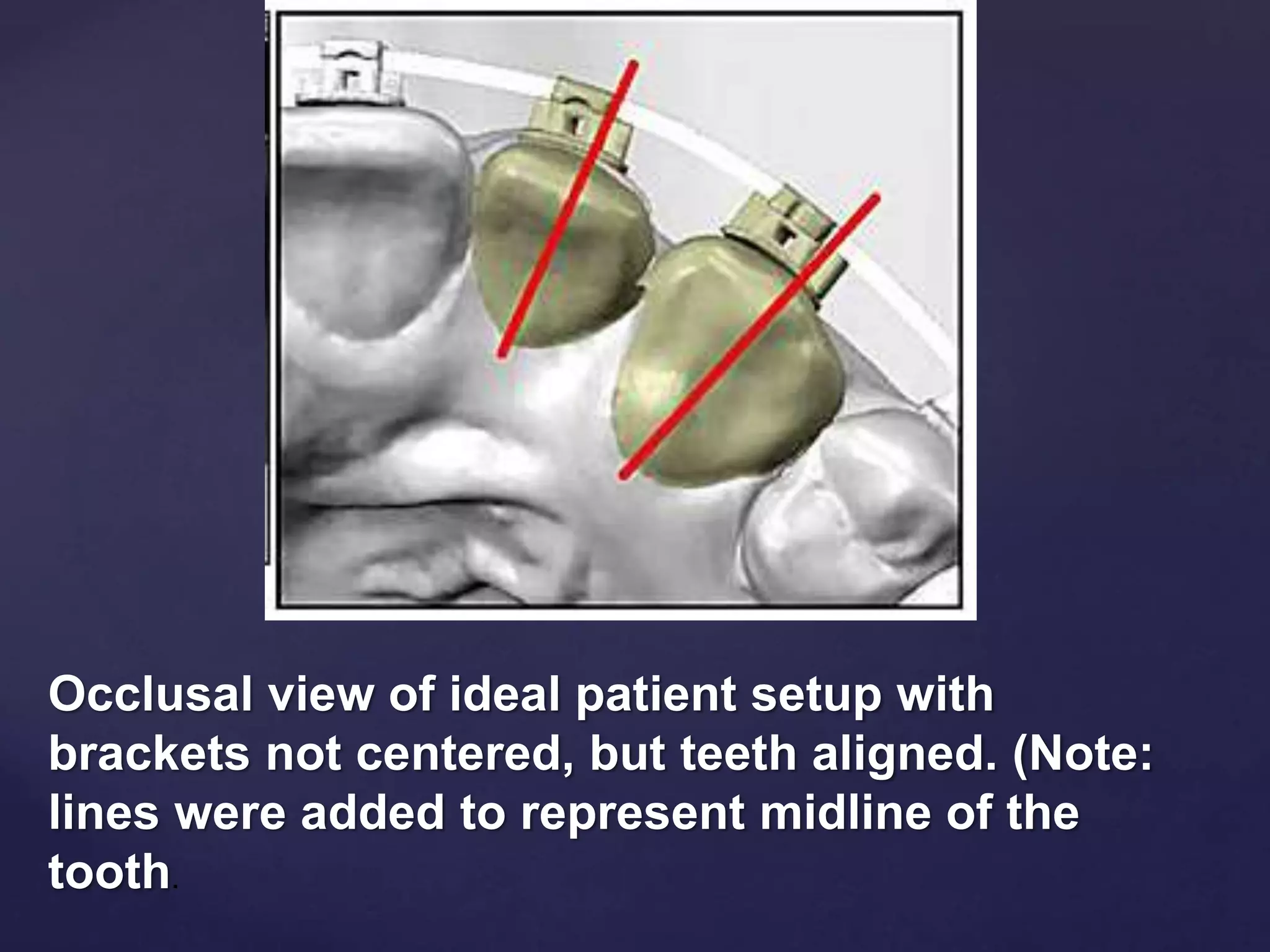 placement of orthodontic brackets | PPTX