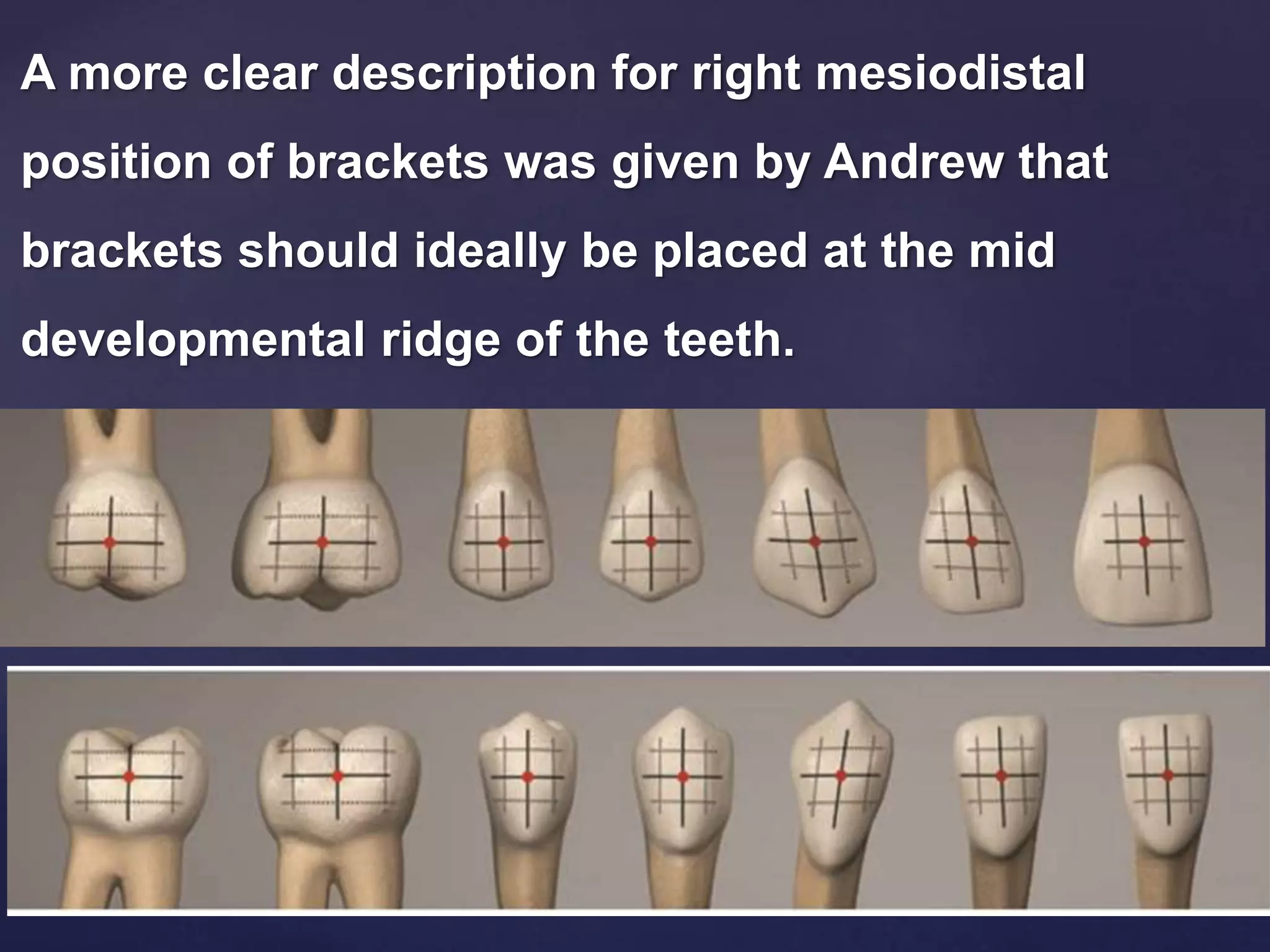 placement of orthodontic brackets | PPTX | Dental Health | Diseases and ...
