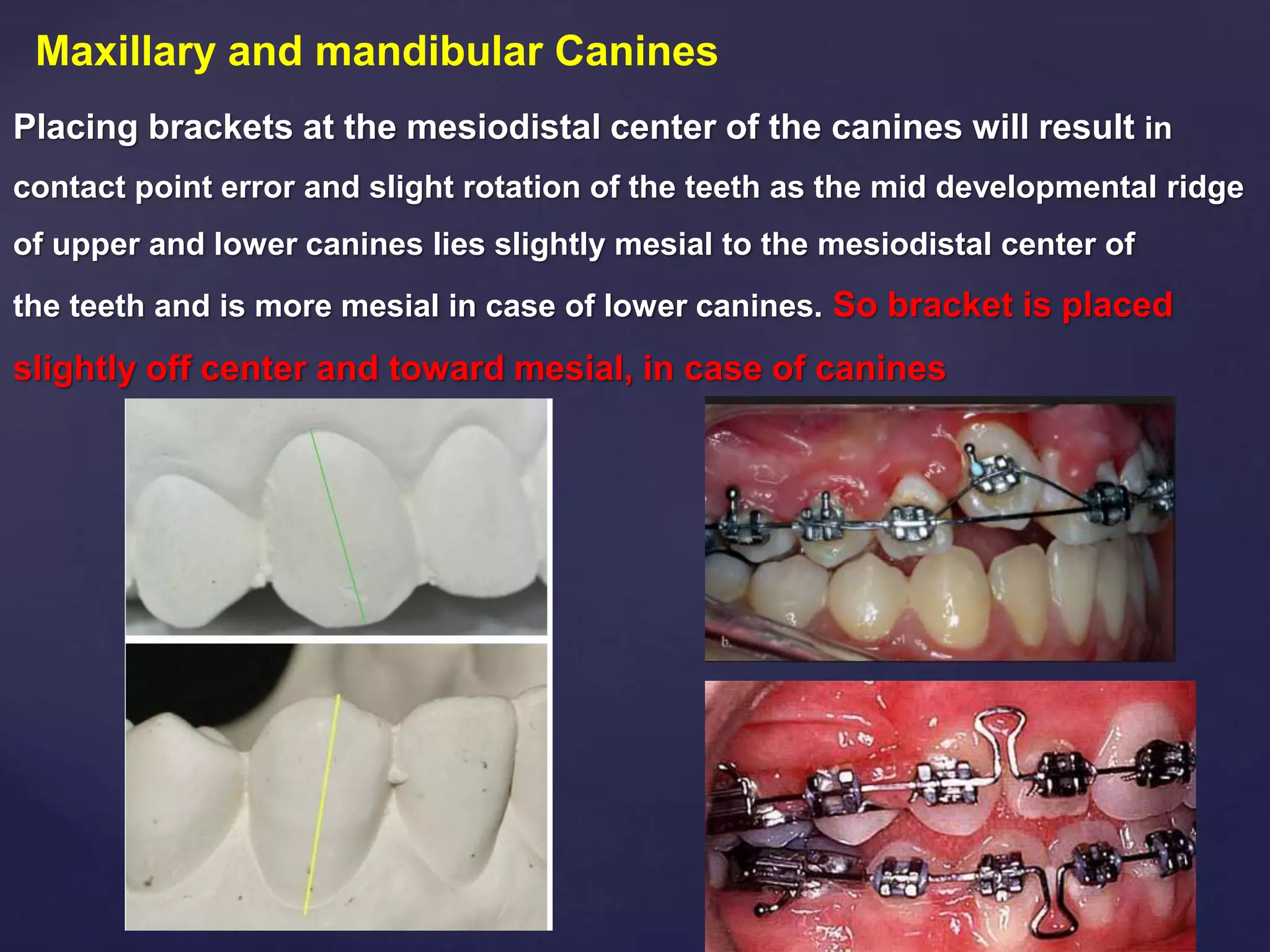 placement of orthodontic brackets | PPTX