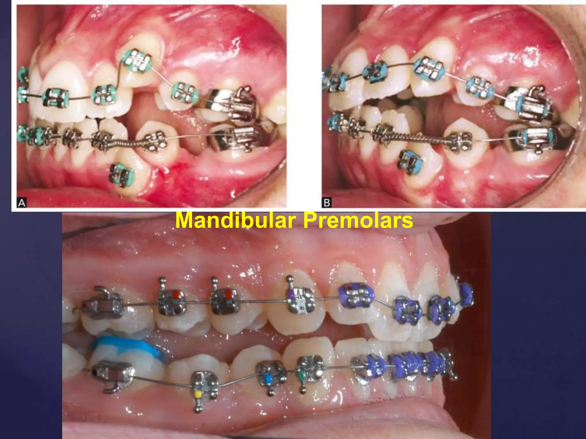 placement of orthodontic brackets | PPTX