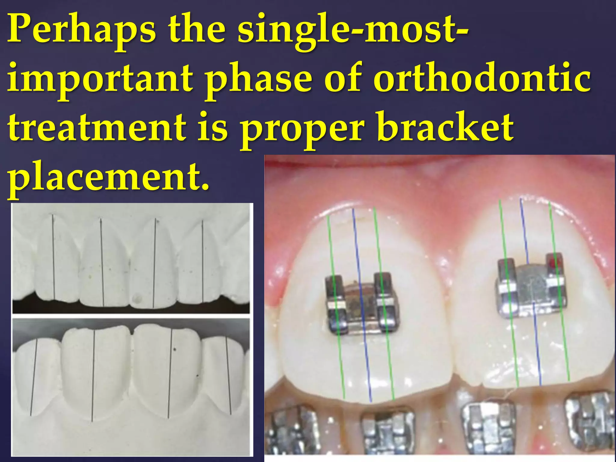 placement of orthodontic brackets | PPTX
