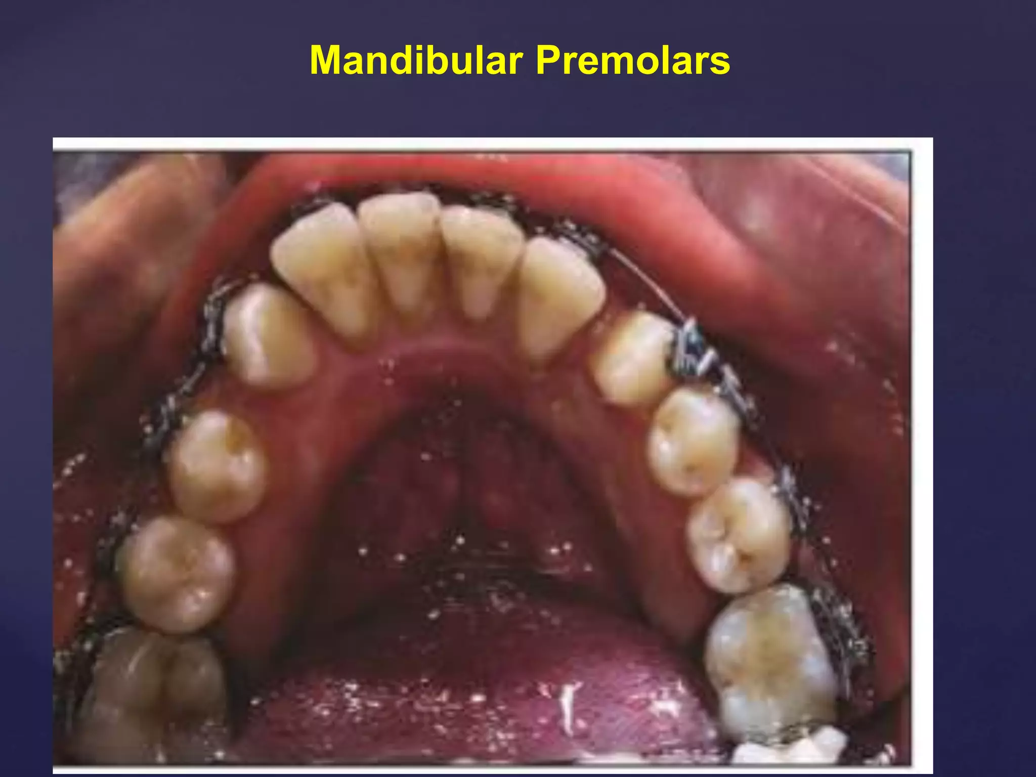placement of orthodontic brackets | PPTX