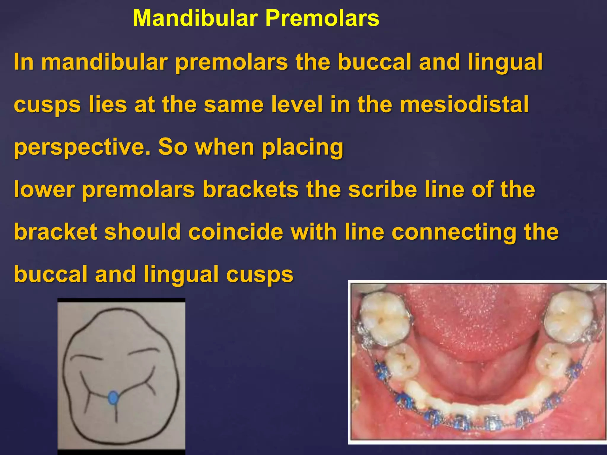 placement of orthodontic brackets | PPTX
