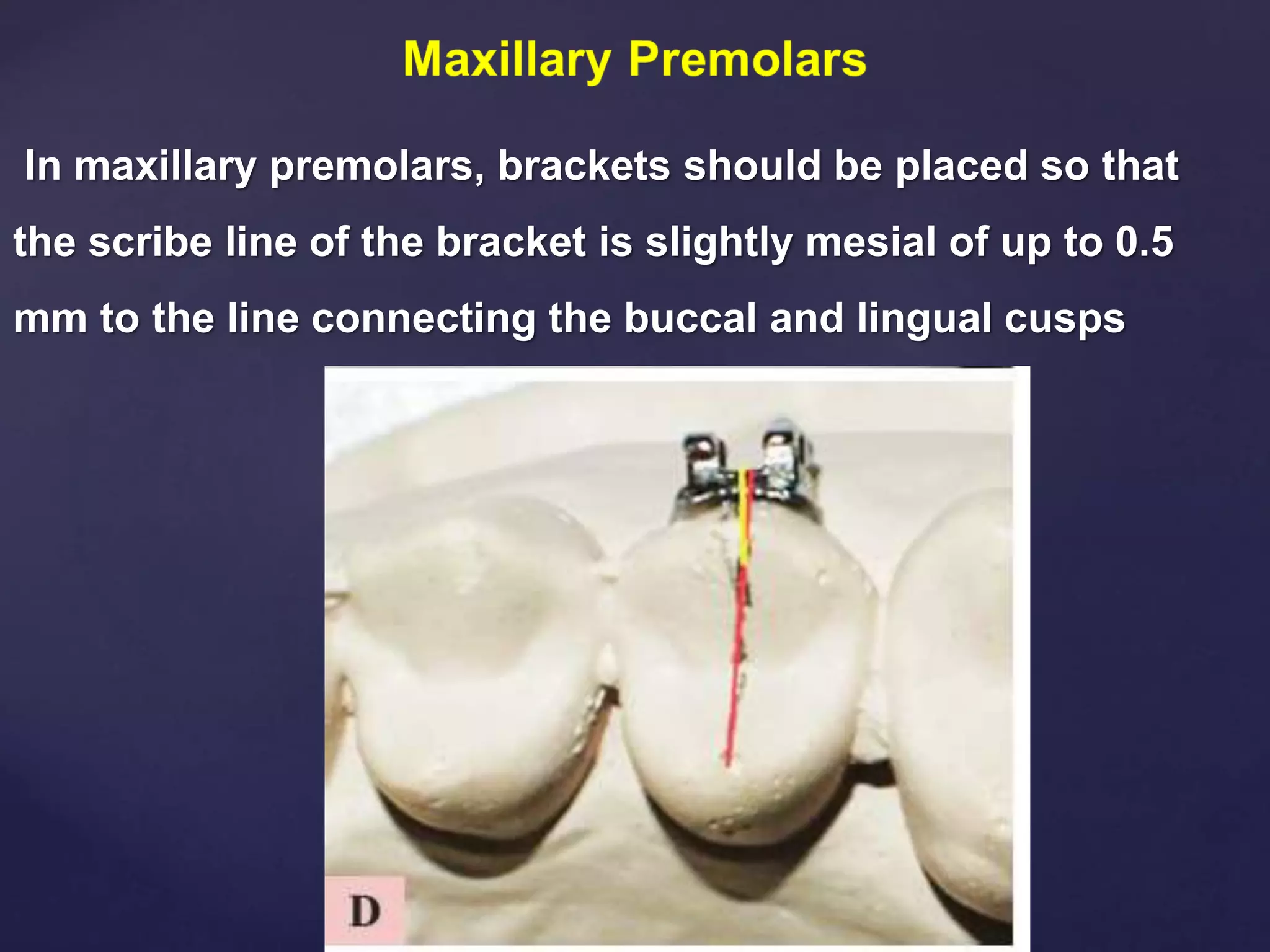 placement of orthodontic brackets | PPTX