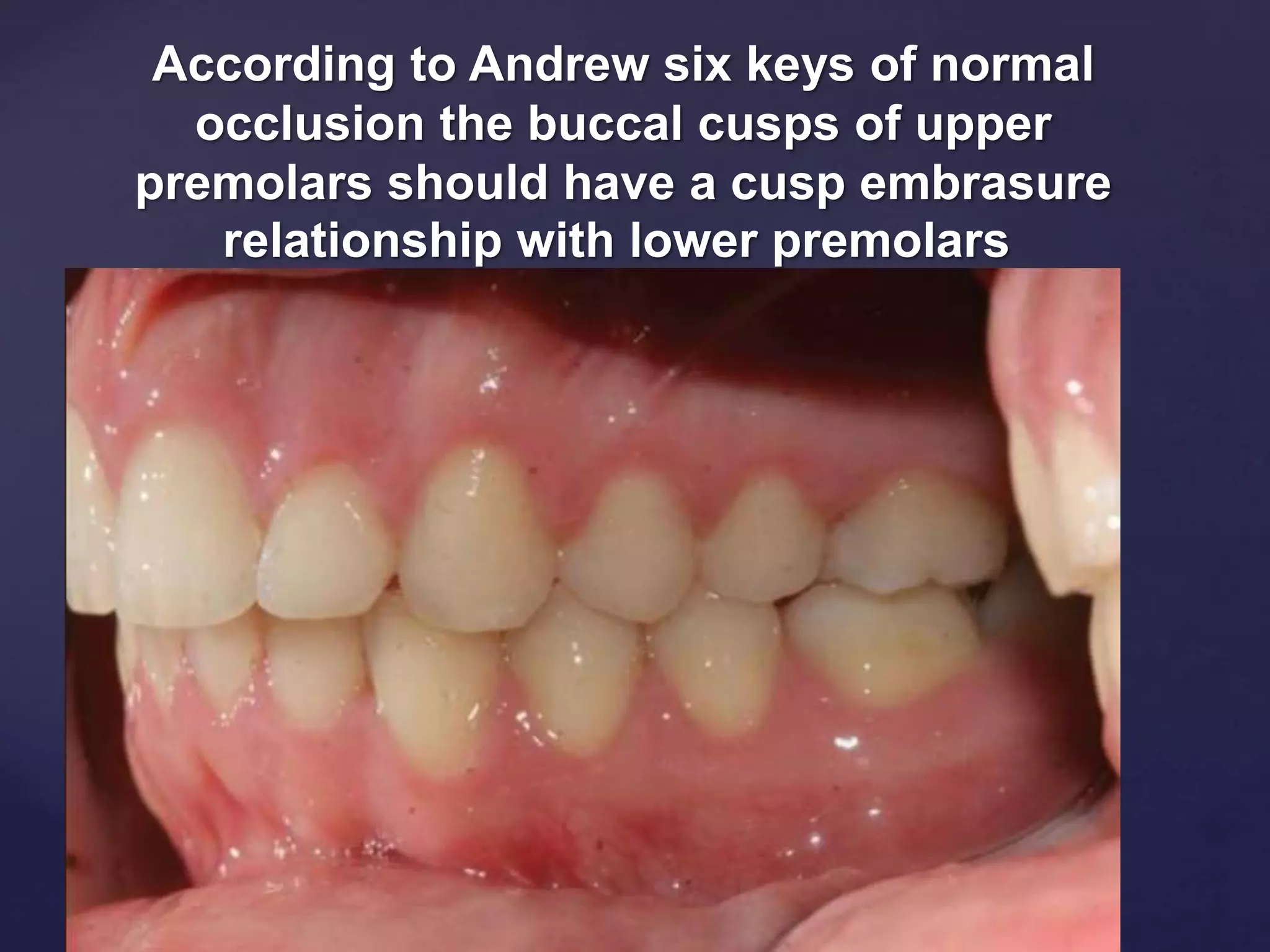 placement of orthodontic brackets | PPTX