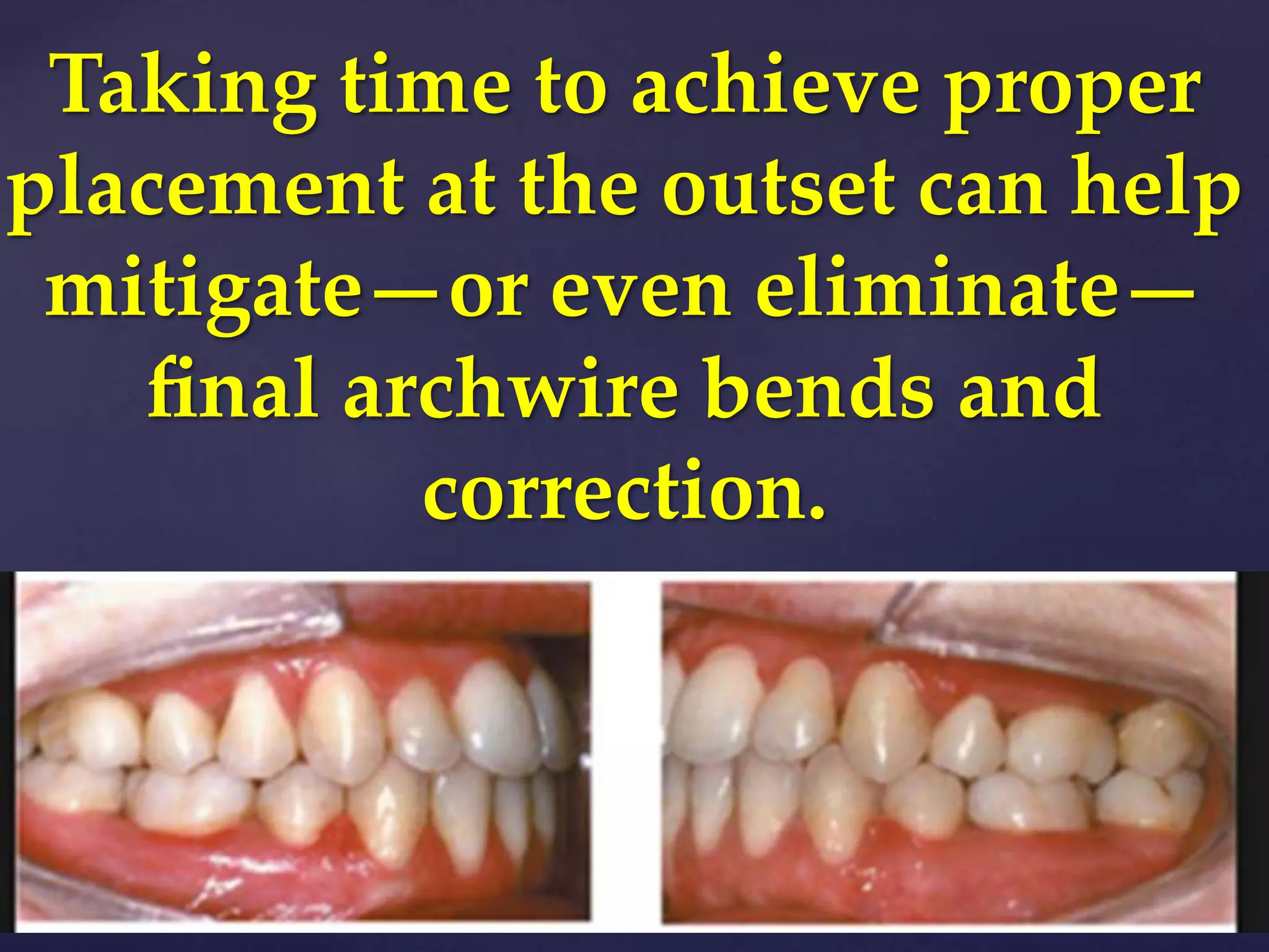 placement of orthodontic brackets | PPTX