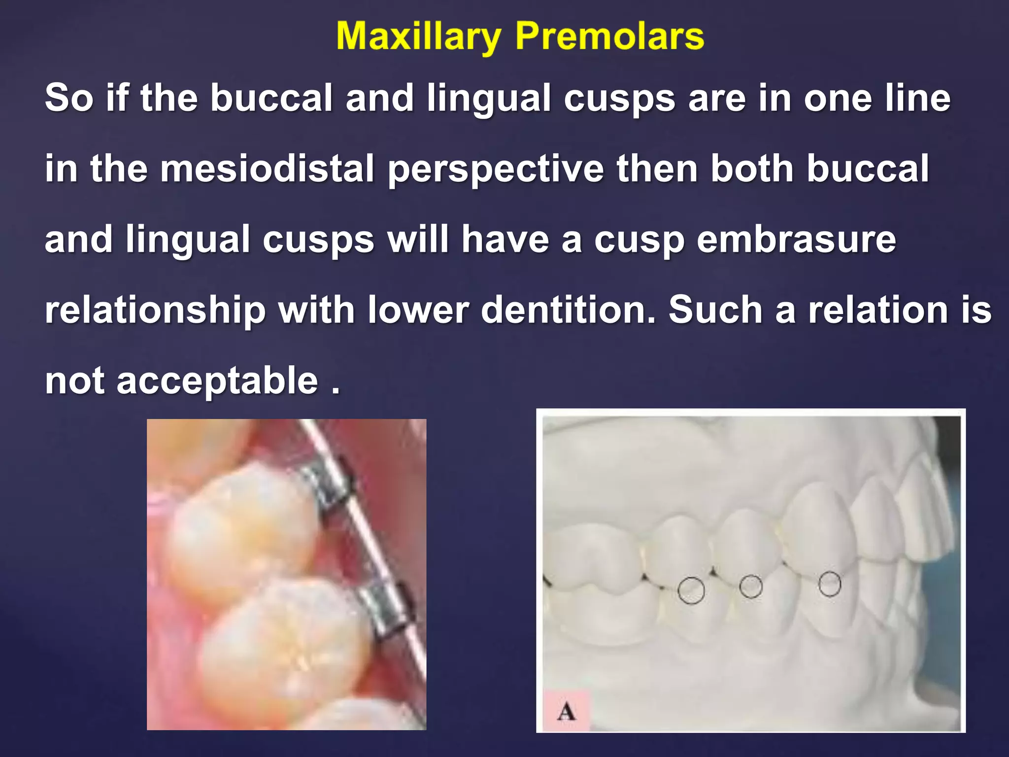 placement of orthodontic brackets | PPTX
