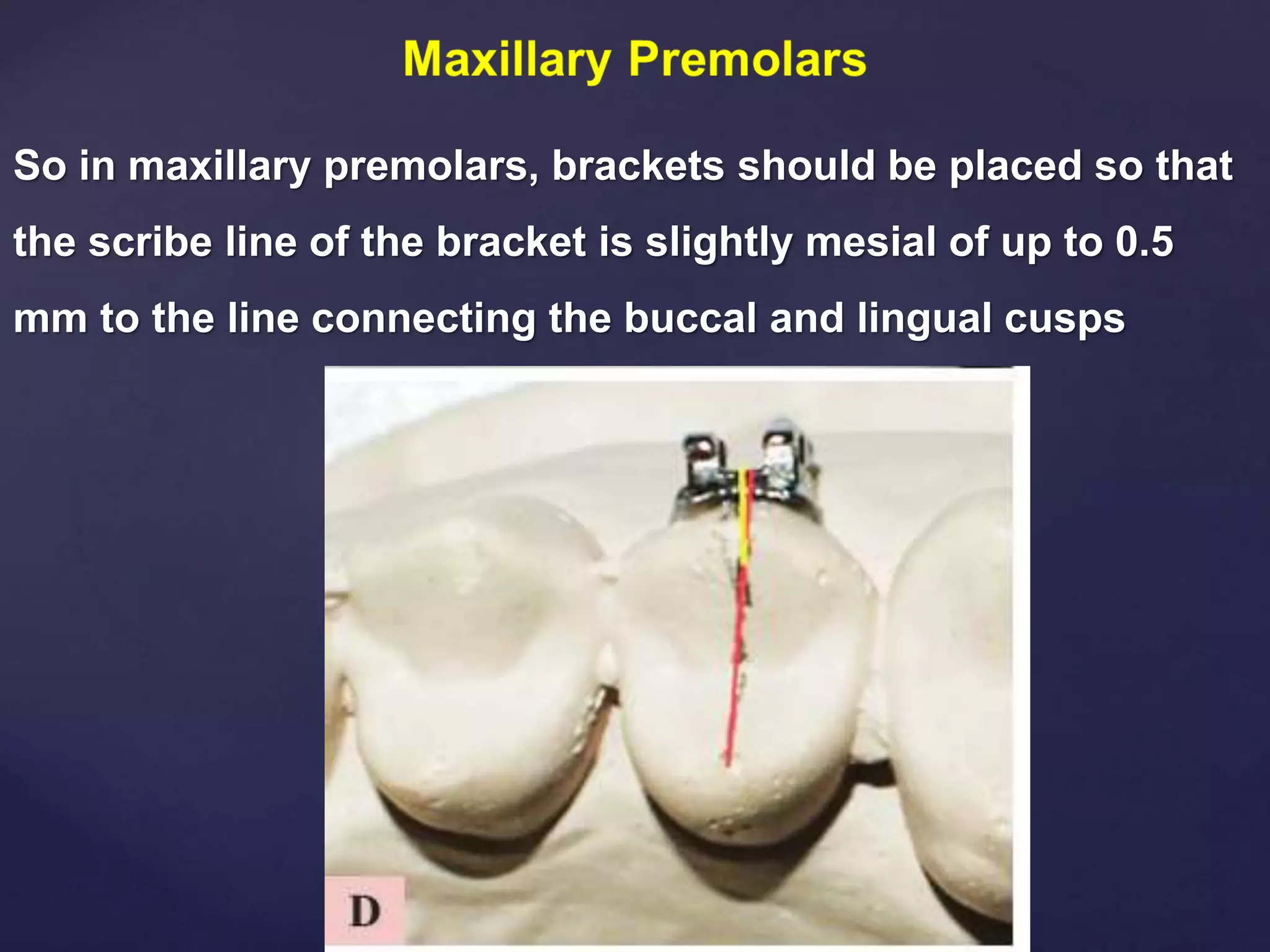 placement of orthodontic brackets | PPTX