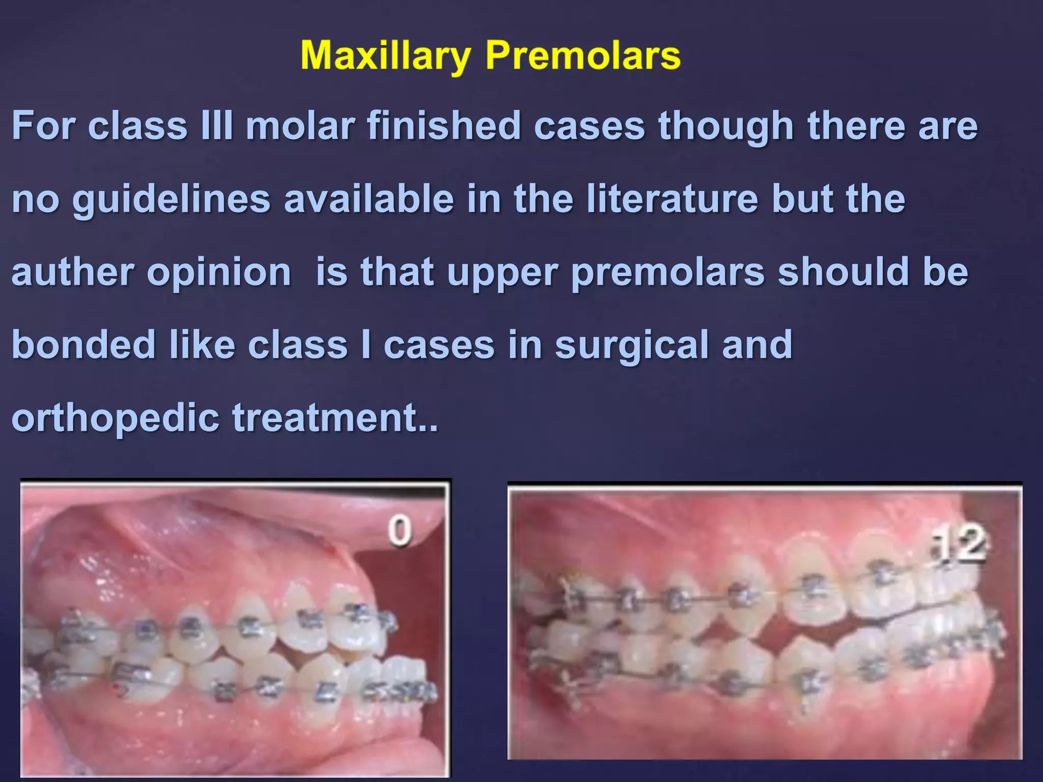 placement of orthodontic brackets | PPTX