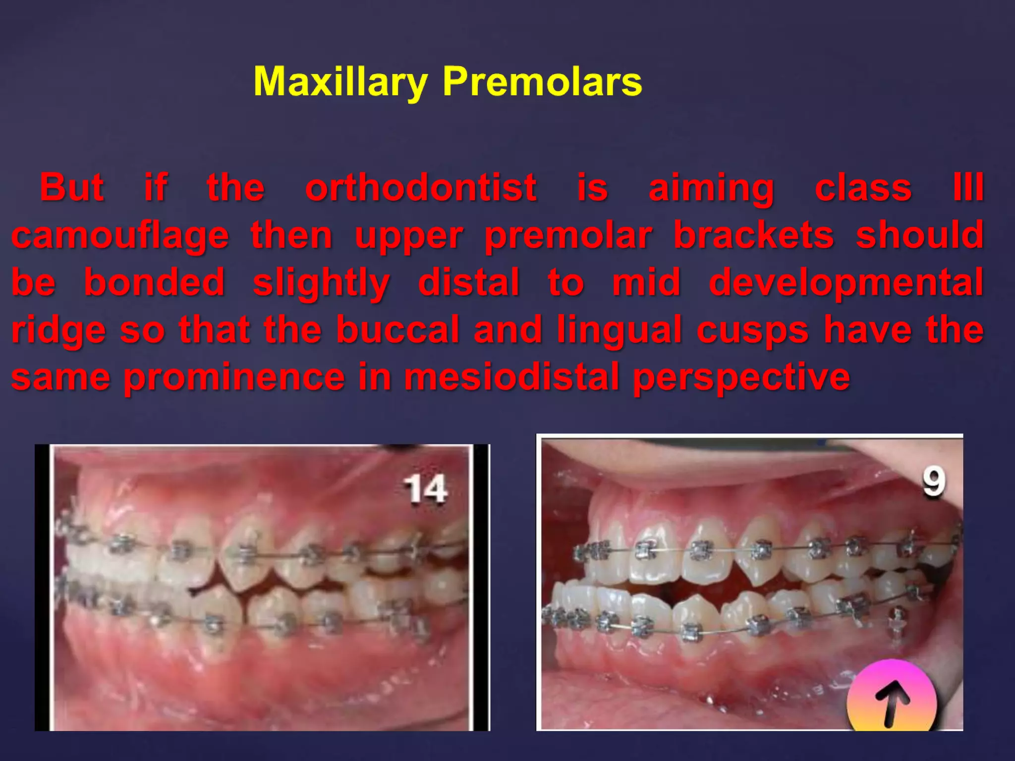 placement of orthodontic brackets | PPTX