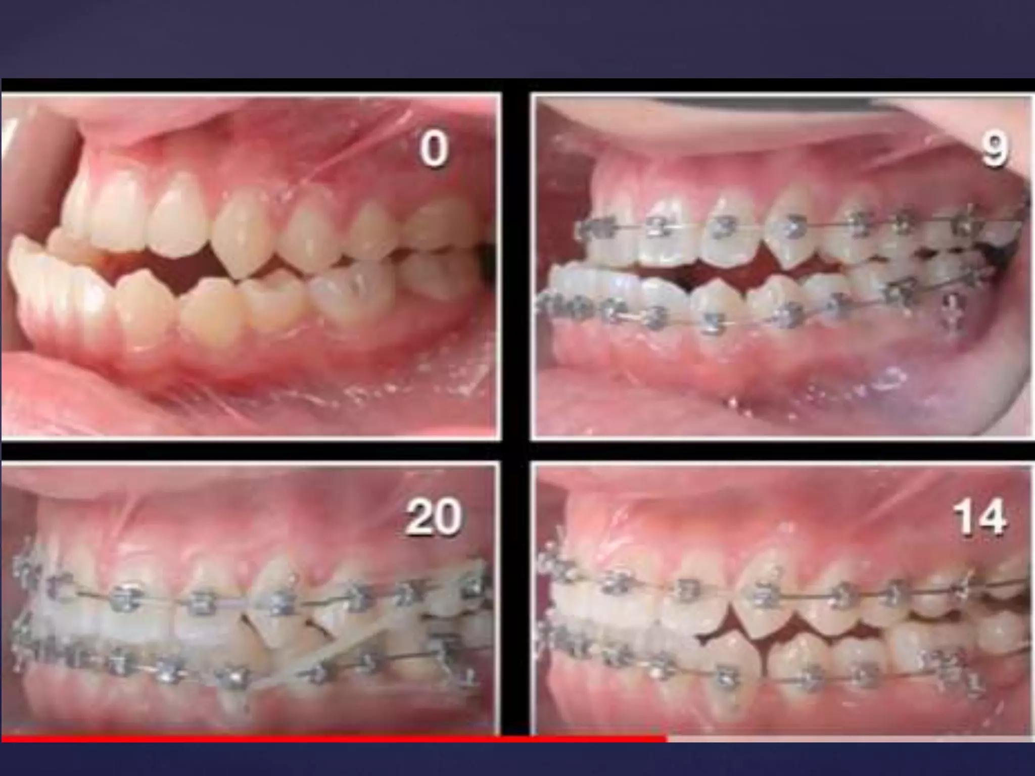 placement of orthodontic brackets | PPTX