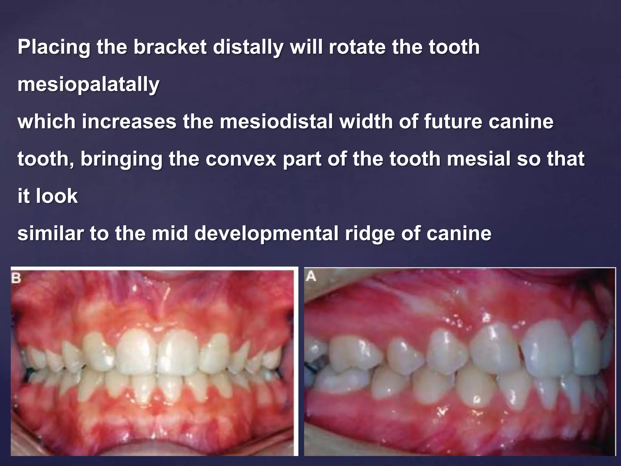 placement of orthodontic brackets | PPTX