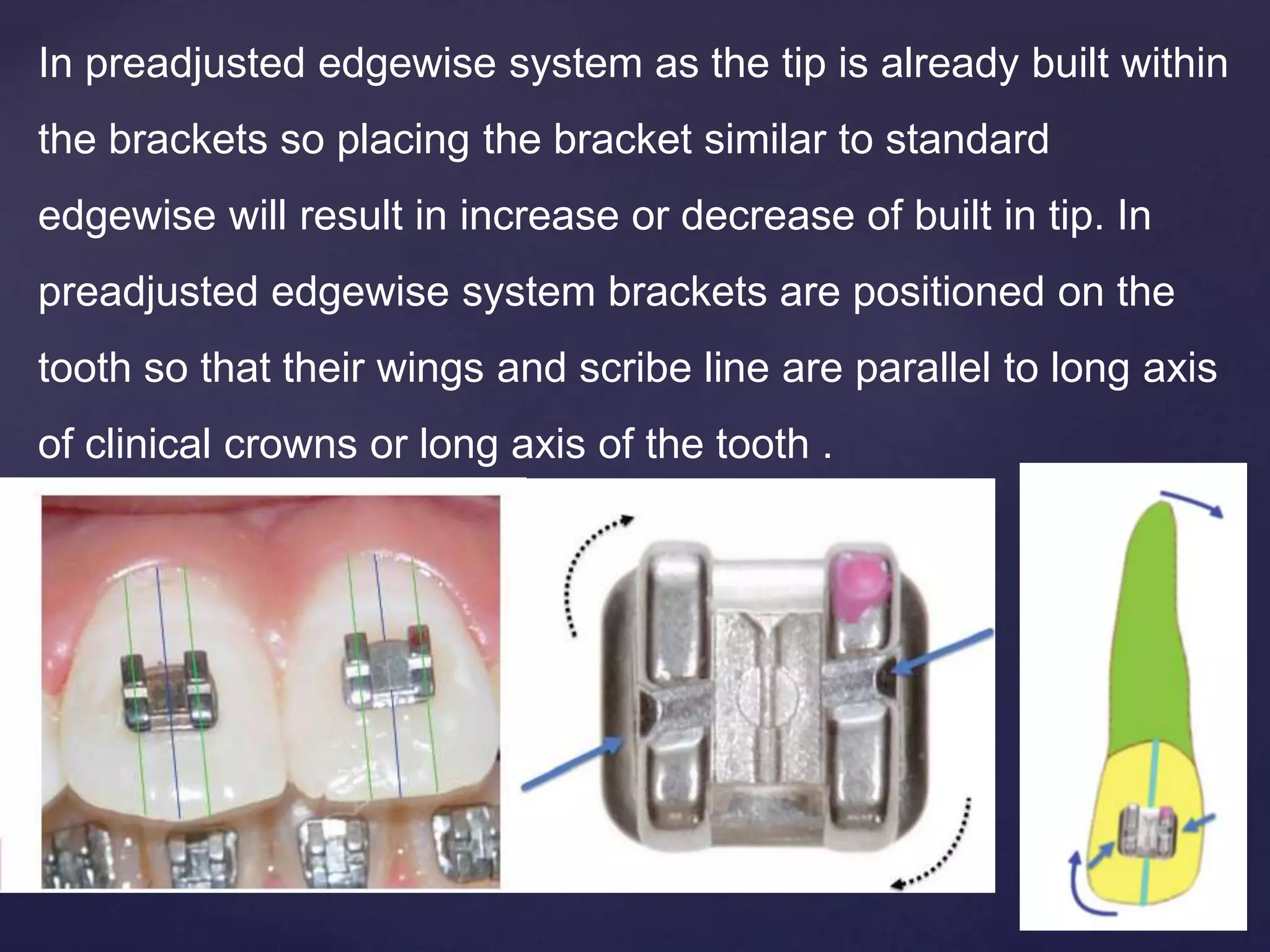 placement of orthodontic brackets | PPTX