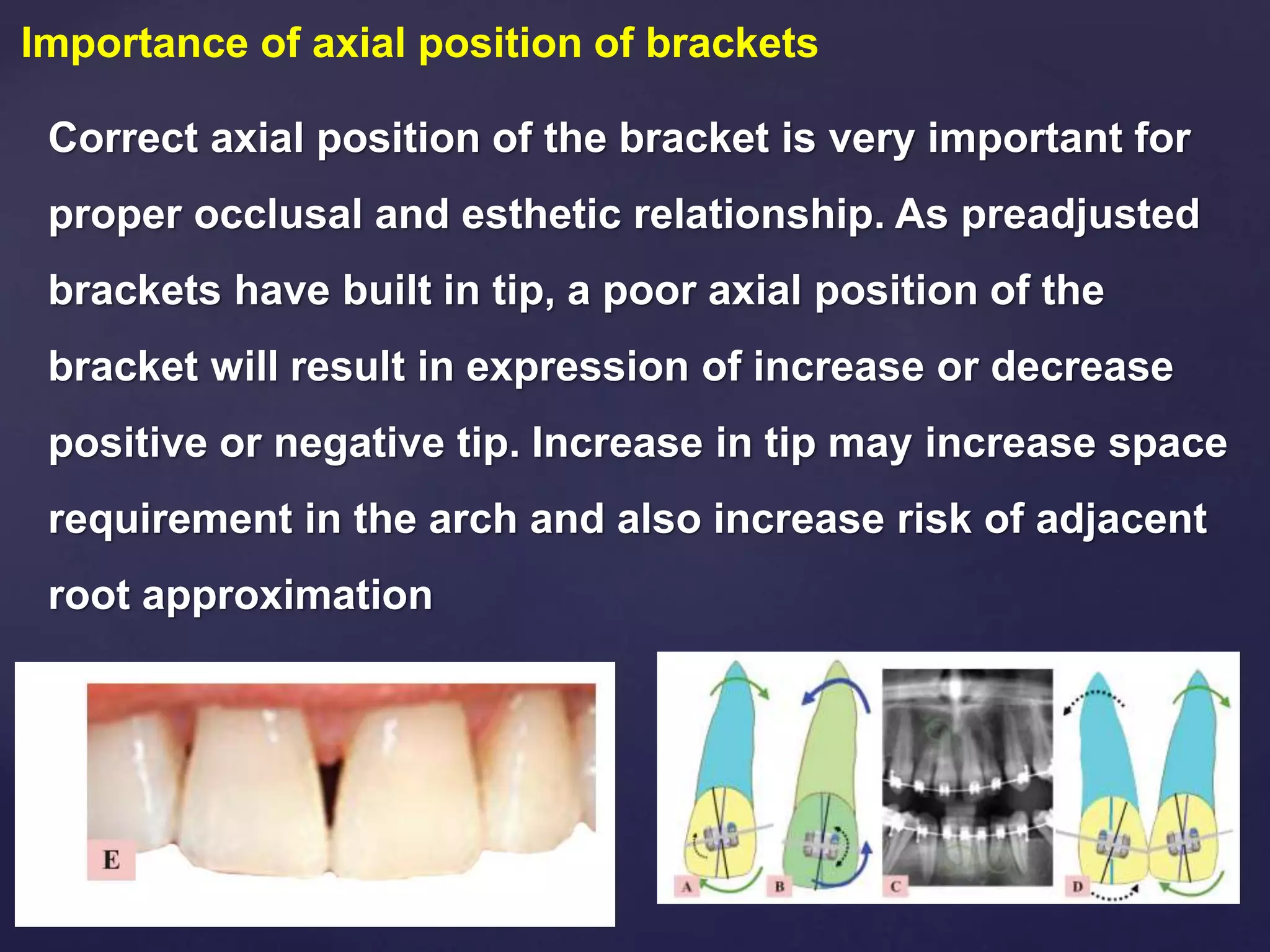 placement of orthodontic brackets | PPTX