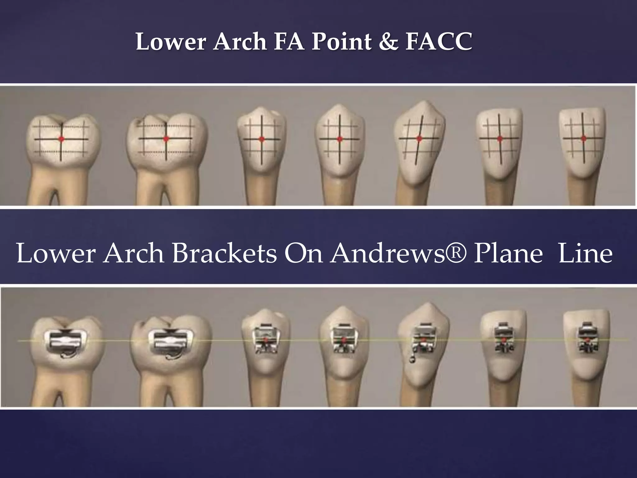 placement of orthodontic brackets | PPTX