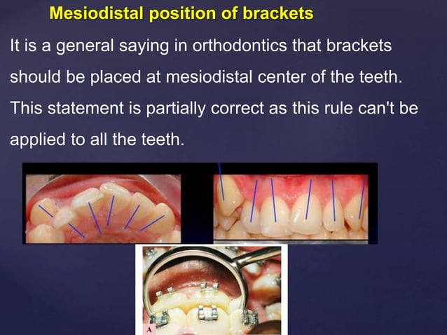 placement of orthodontic brackets | PPTX | Dental Health | Diseases and ...
