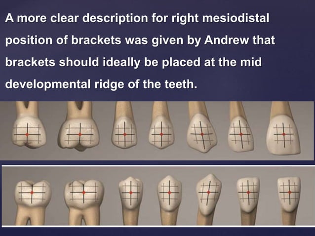 placement of orthodontic brackets | PPT