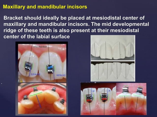 placement of orthodontic brackets | PPT