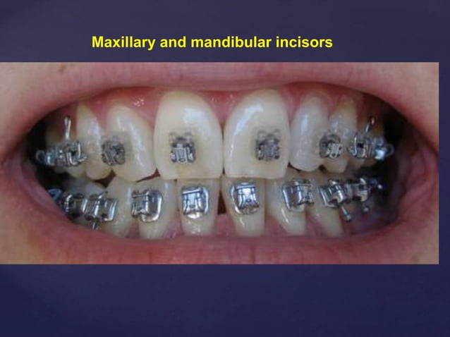 placement of orthodontic brackets | PPTX | Dental Health | Diseases and ...