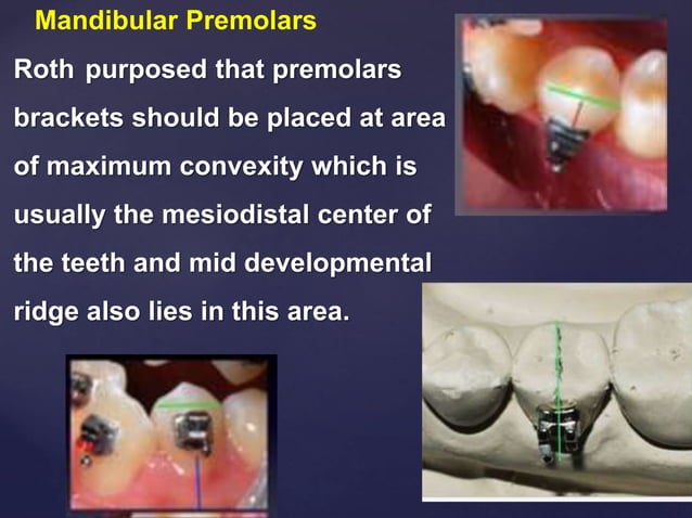 placement of orthodontic brackets | PPT