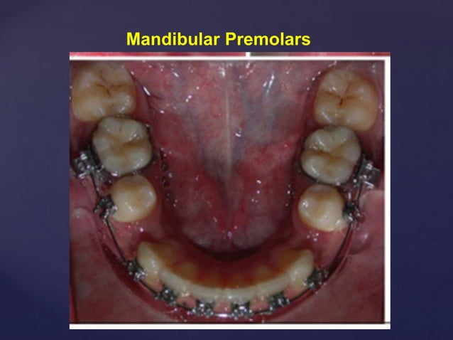 placement of orthodontic brackets | PPTX | Dental Health | Diseases and ...