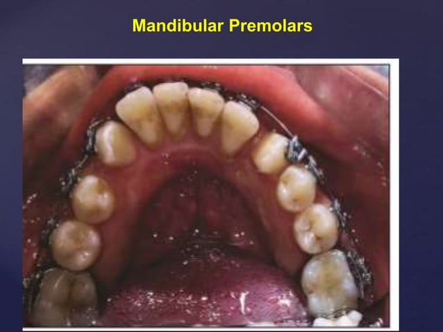placement of orthodontic brackets | PPT