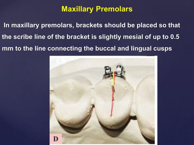 placement of orthodontic brackets | PPTX | Dental Health | Diseases and ...