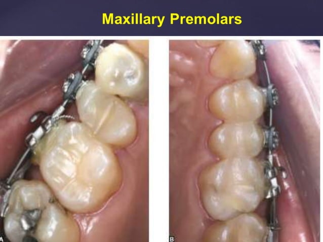 placement of orthodontic brackets | PPTX | Dental Health | Diseases and ...