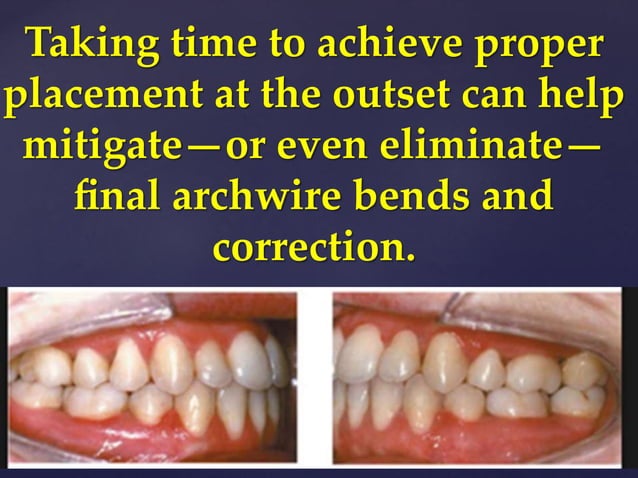 placement of orthodontic brackets | PPT