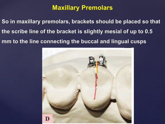 placement of orthodontic brackets | PPTX | Dental Health | Diseases and ...