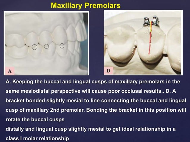 placement of orthodontic brackets | PPT