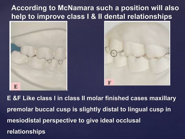 placement of orthodontic brackets | PPTX | Dental Health | Diseases and ...
