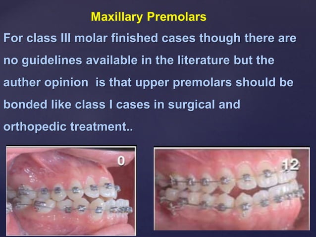 placement of orthodontic brackets | PPTX | Dental Health | Diseases and ...