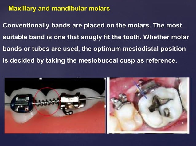 placement of orthodontic brackets | PPT