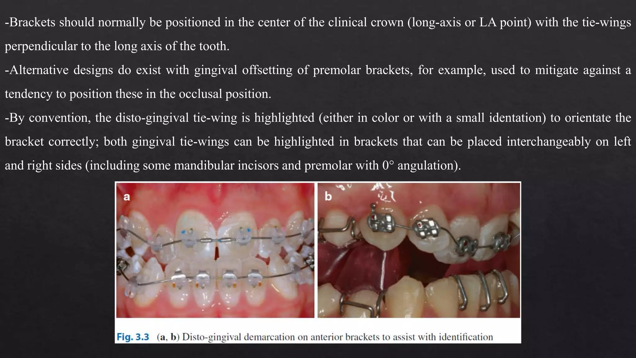 Bracket placement and positioning (dr nayaungbds phd) | PPTX