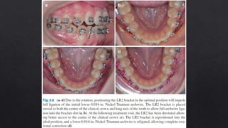 Bracket placement and positioning (dr nayaungbds phd) | PPTX