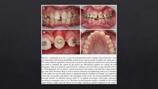 Bracket placement and positioning (dr nayaungbds phd) | PPTX