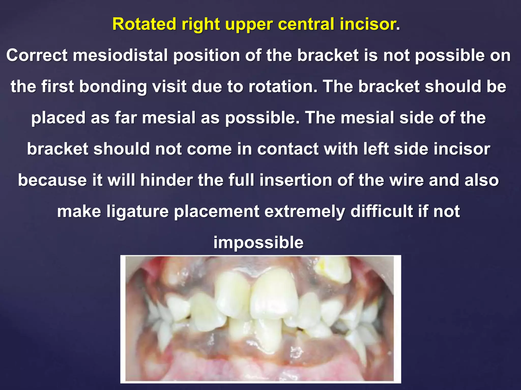 Bracket Placement .Prof. Maher Fouda | PPTX