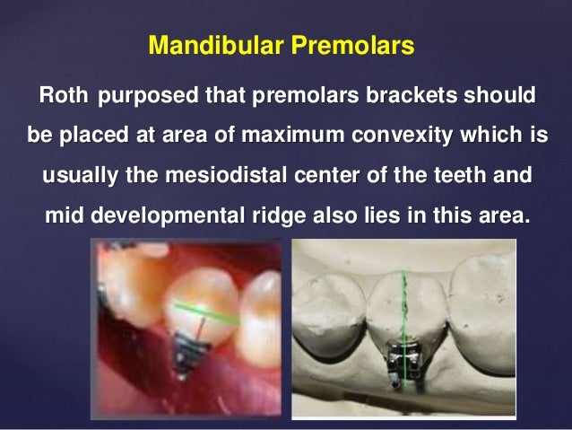 Bracket Placement .Prof. Maher Fouda