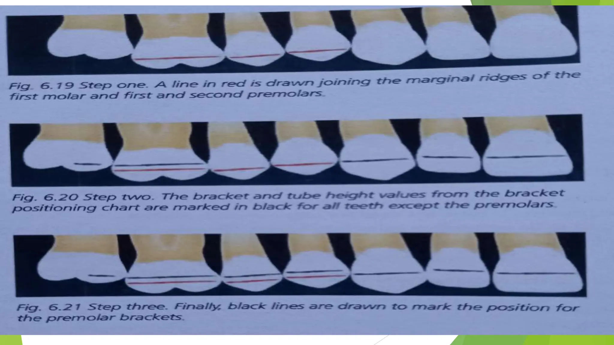 bracket positioning in orthodontics.pptx